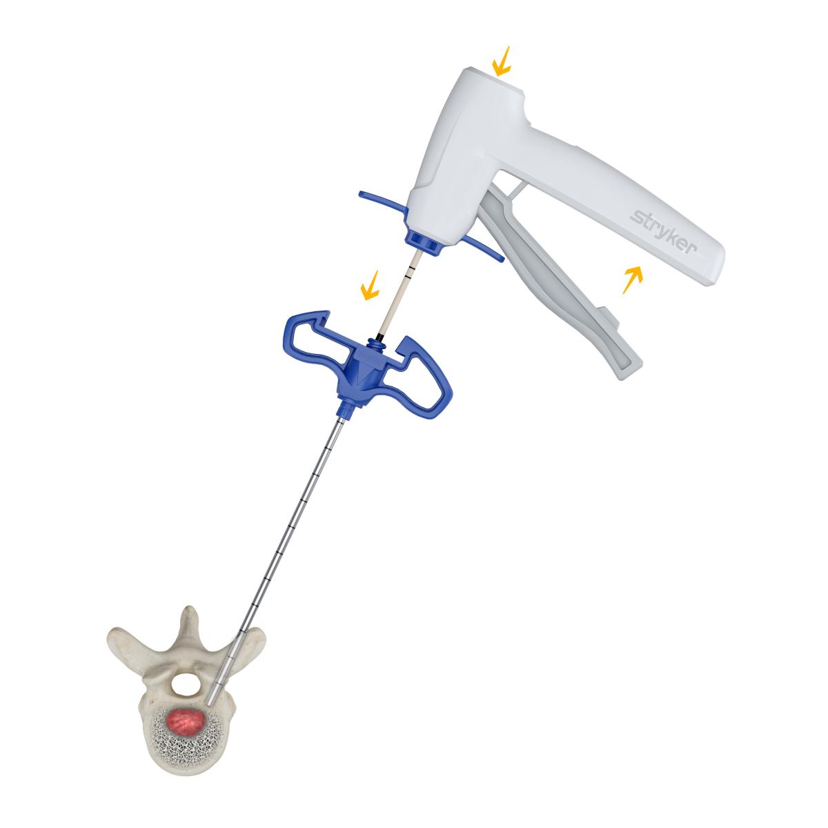 Bone tumor ablation | Interventional Spine