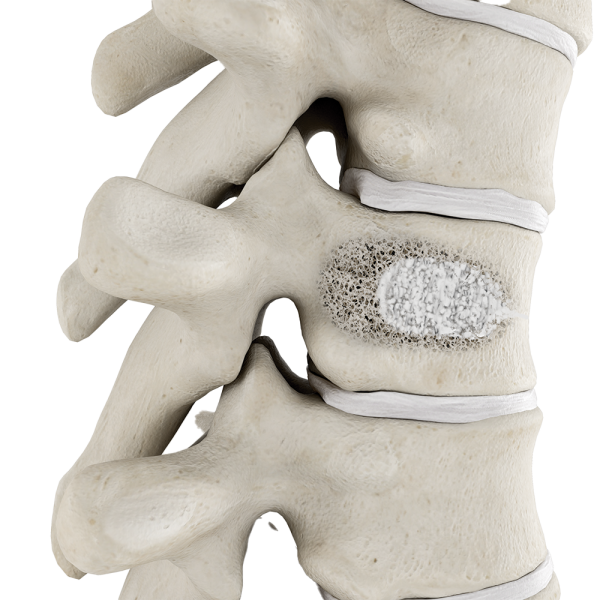 Vertebroplasty | Interventional Spine