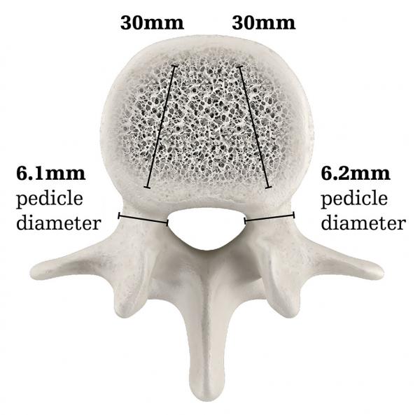 SpineJack procedure | Interventional Spine