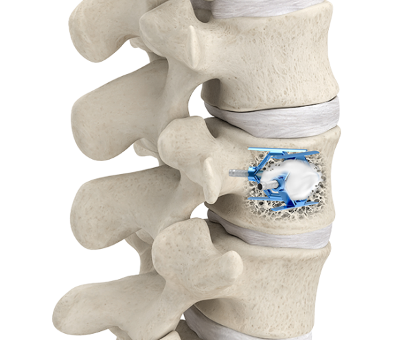 SpineJack procedure | Interventional Spine