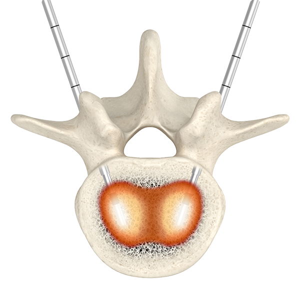 Bone tumor ablation | Interventional Spine Bone tumor ablation | Interventional Spine