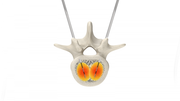 Bone tumor ablation | Interventional Spine