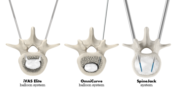 Bone tumor ablation | Interventional Spine