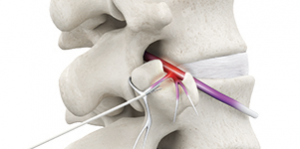 RF ablation | Interventional Spine