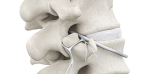 RF ablation | Interventional Spine