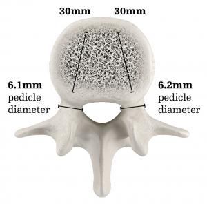 SpineJack procedure | Interventional Spine