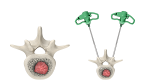 Bone tumor ablation | Interventional Spine