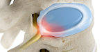 Disc decompression | Interventional Spine