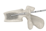 SpineJack procedure | Interventional Spine