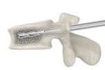 SpineJack procedure | Interventional Spine