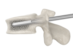 SpineJack procedure | Interventional Spine