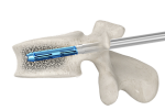 SpineJack procedure | Interventional Spine