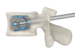 SpineJack procedure | Interventional Spine